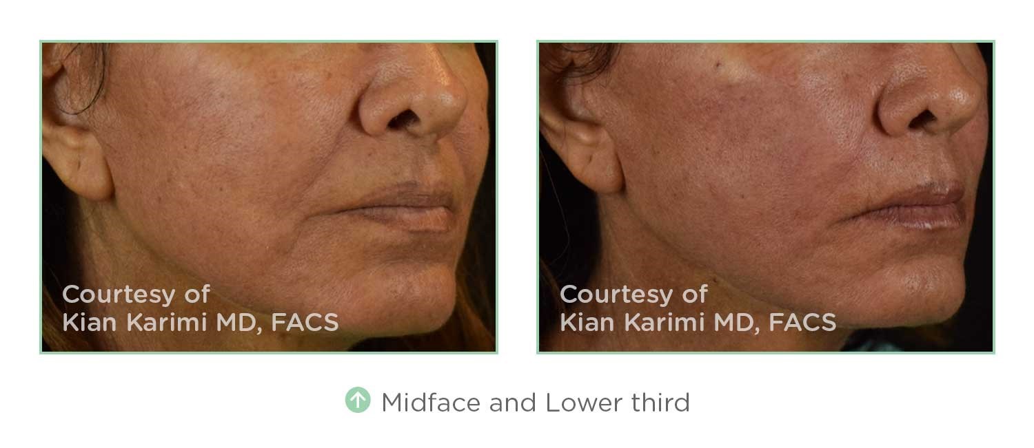 NovaThreads PDO Thread Lift, Mesh and Twists